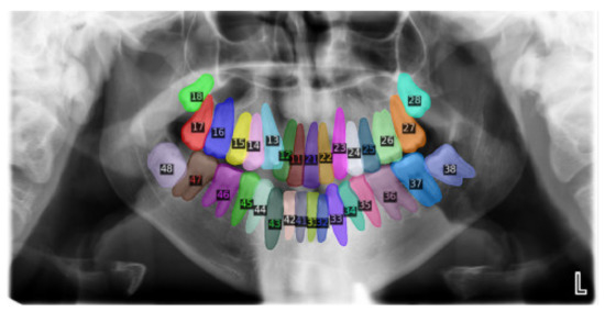 Teeth Segmentation in Panoramic Dental X-ray Using Mask Regional Convolutional Neural Network