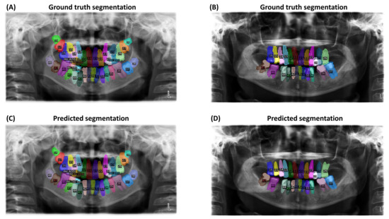 Teeth Segmentation in Panoramic Dental X-ray Using Mask Regional ...
