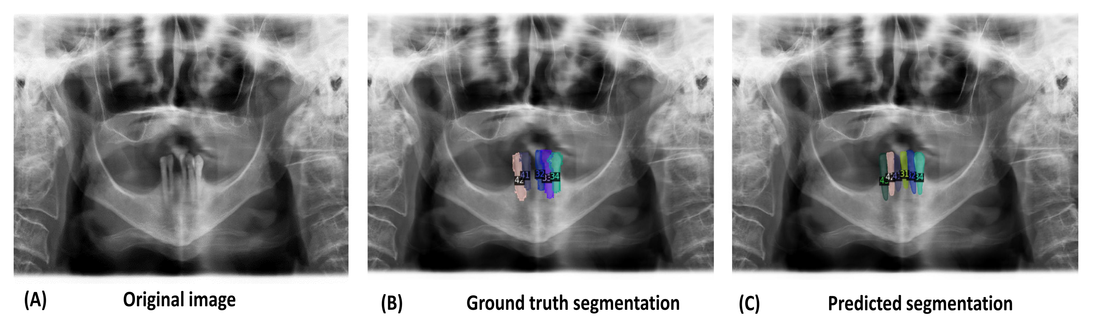 Teeth Segmentation in Panoramic Dental X-ray Using Mask Regional Convolutional Neural Network