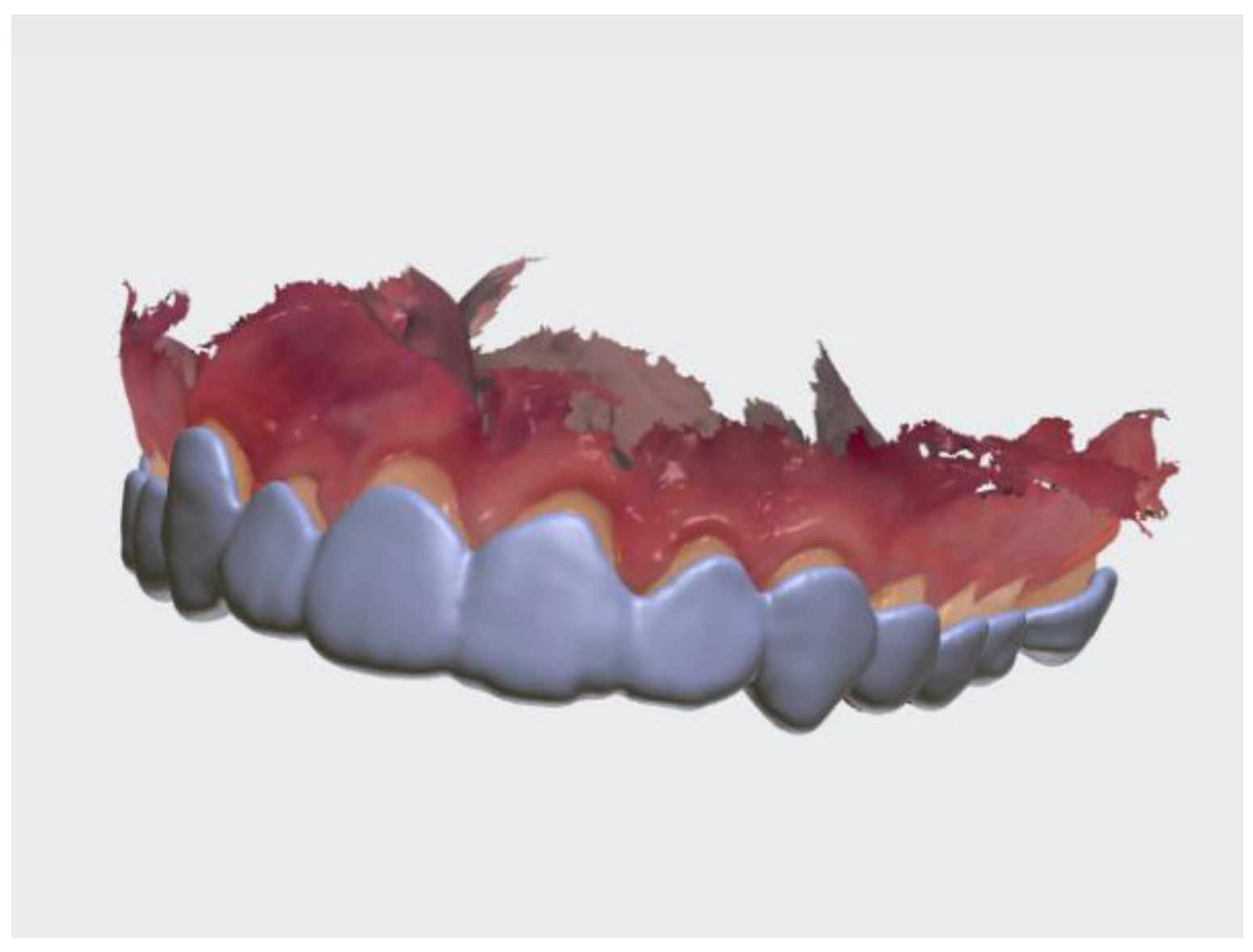 T-Scan Novus System Application—Digital Occlusion Analysis of 3D Printed Orthodontics Retainers