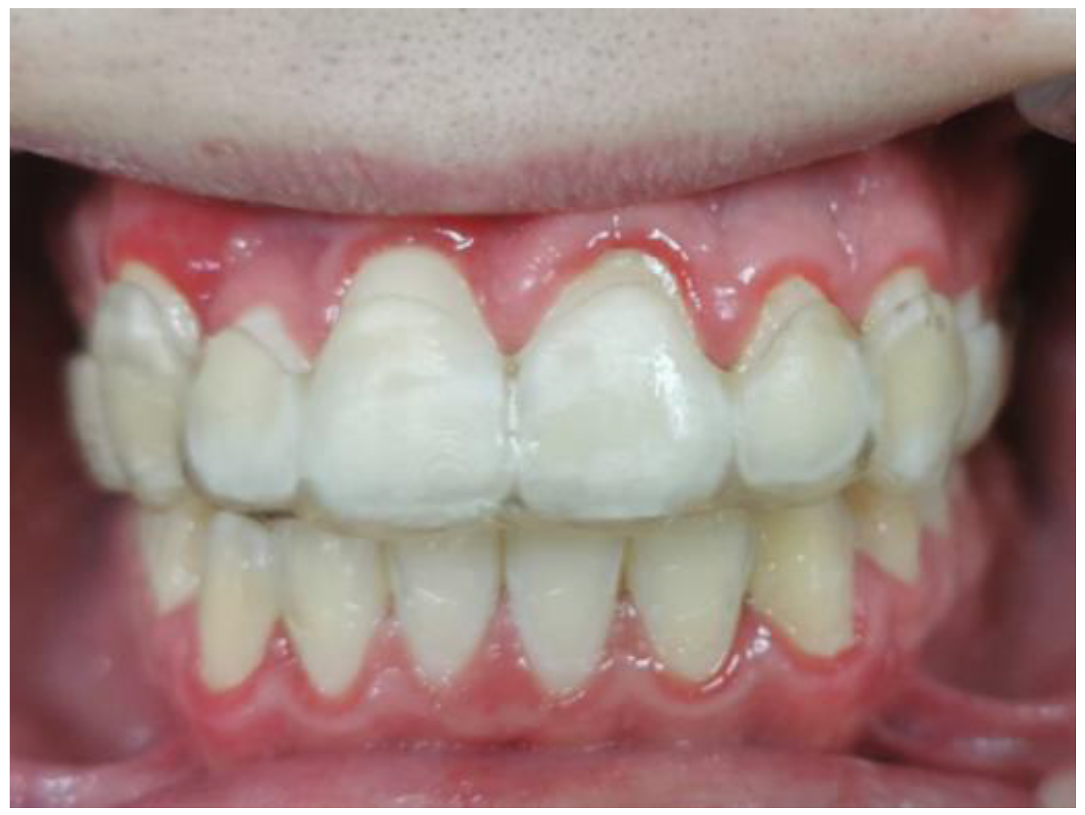 T-Scan Novus System Application—Digital Occlusion Analysis of 3D ...