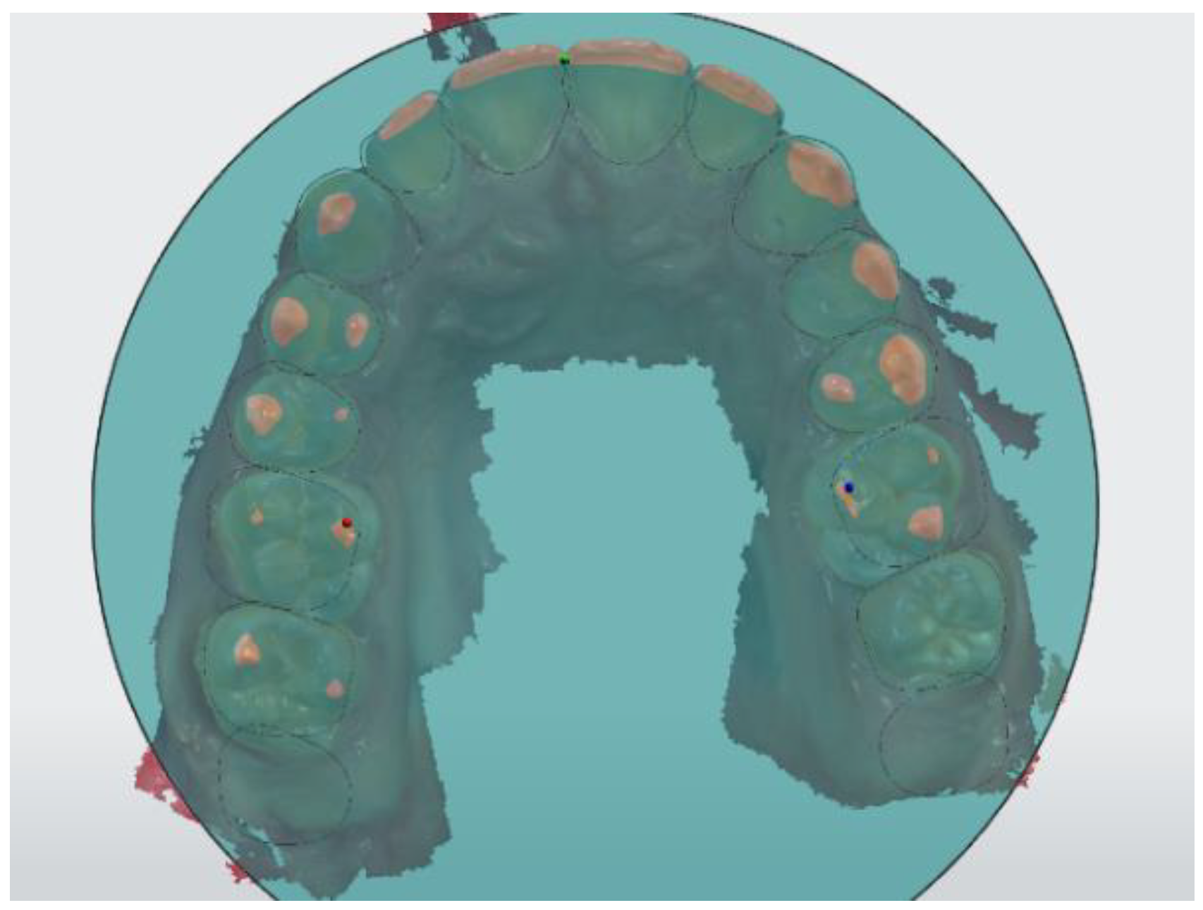 T-Scan Novus System Application—Digital Occlusion Analysis of 3D ...