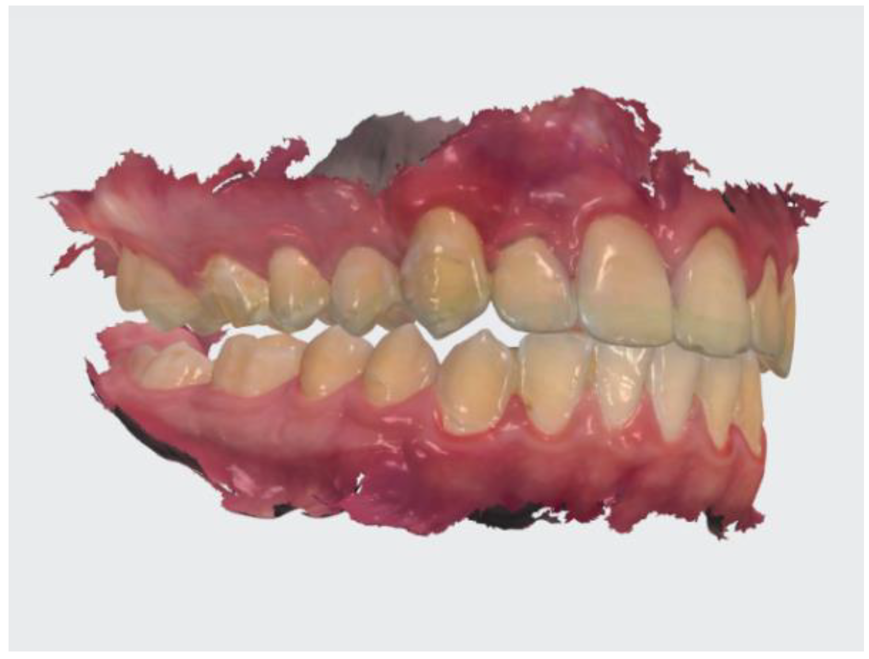 T-Scan Novus System Application—Digital Occlusion Analysis of 3D ...