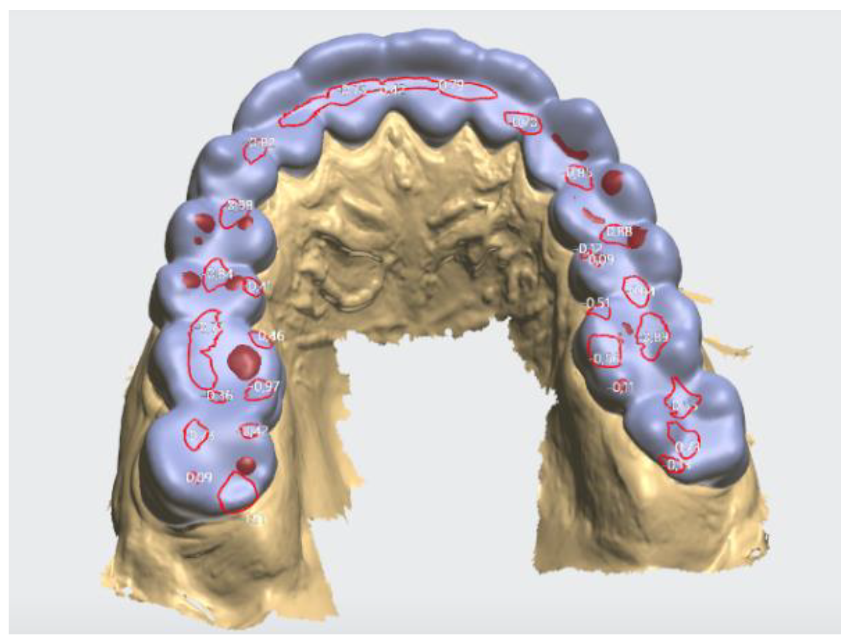 T-Scan Novus System Application—Digital Occlusion Analysis of 3D ...