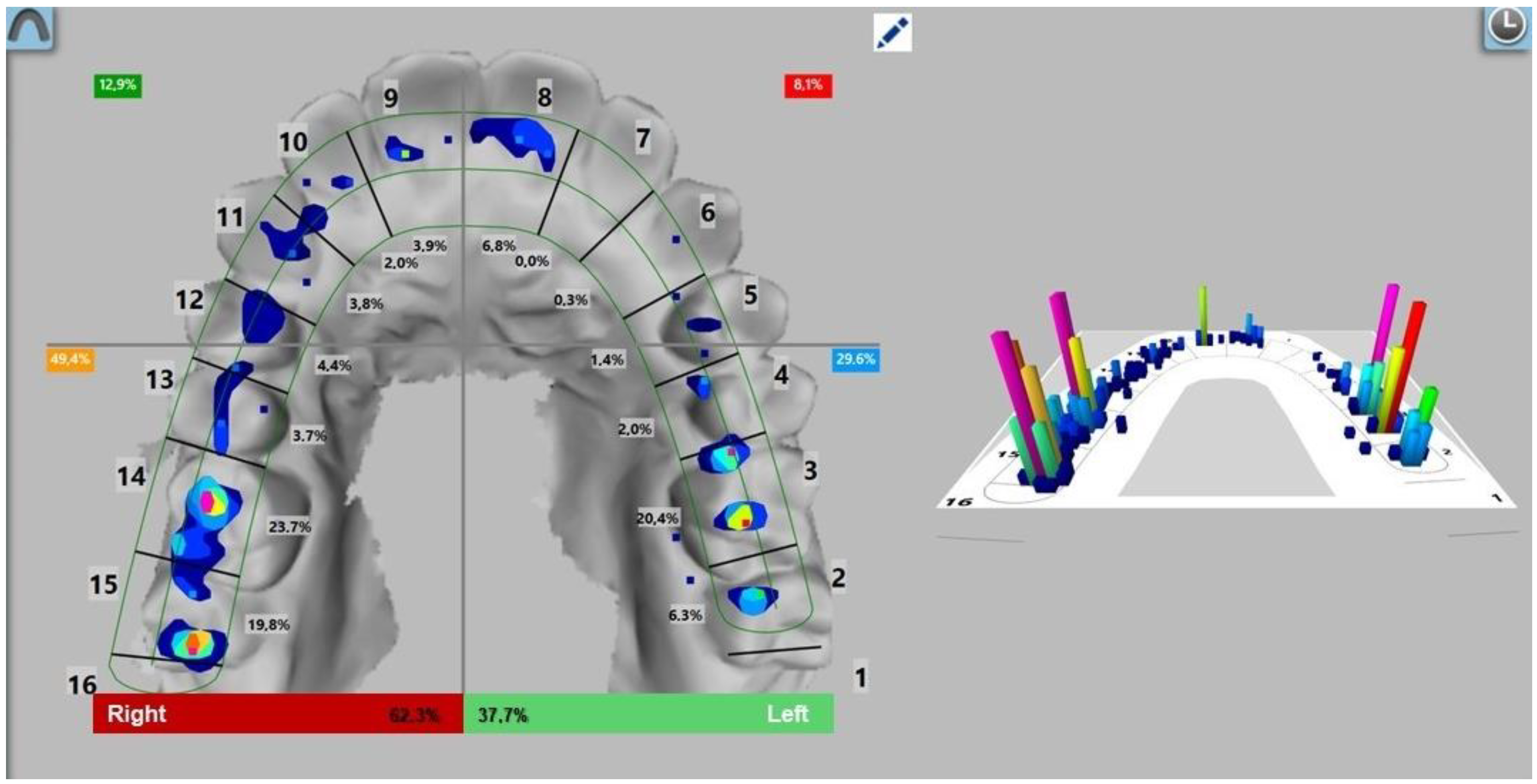 T-Scan Novus System Application—Digital Occlusion Analysis of 3D ...
