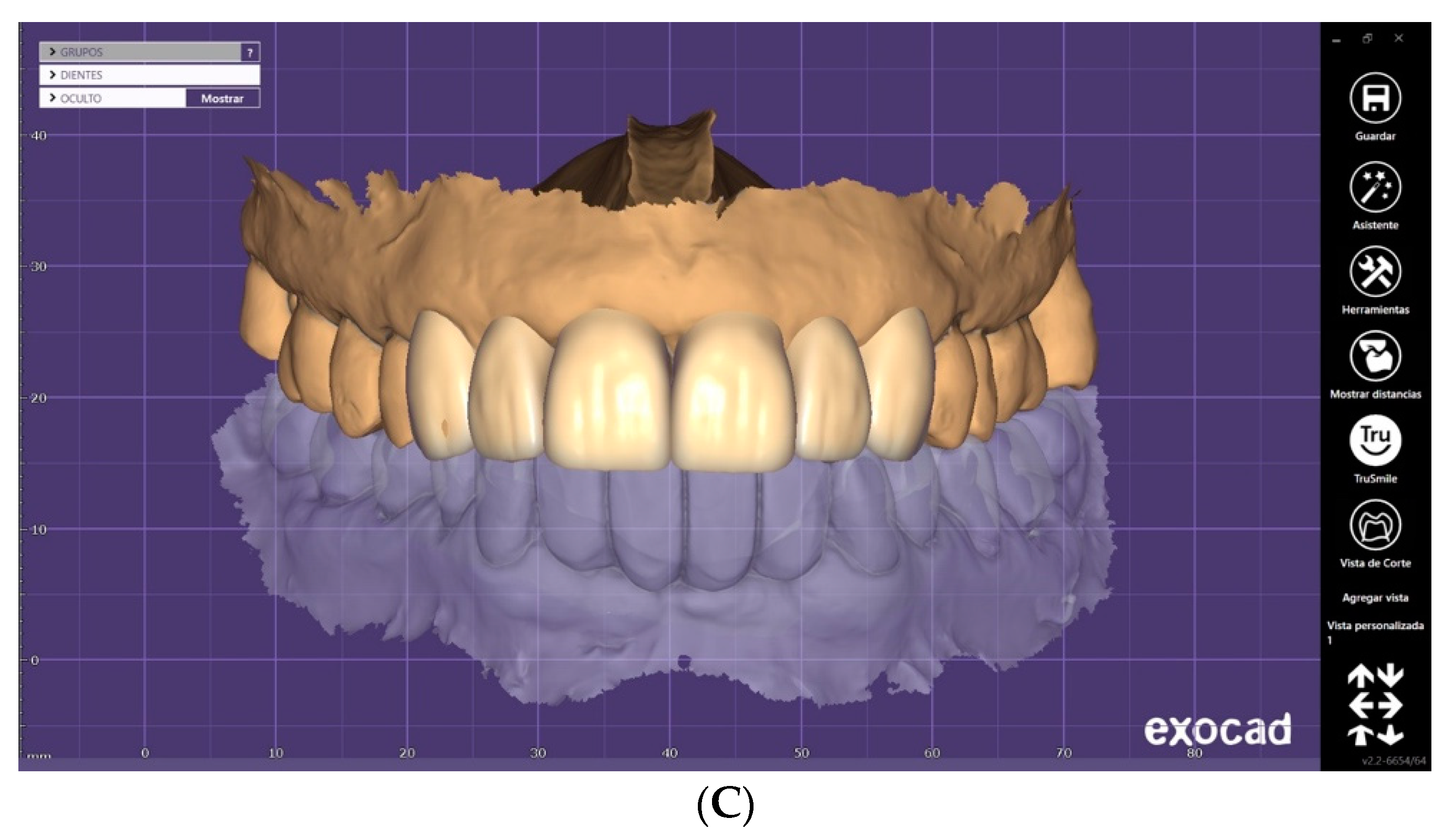 Patient Satisfaction with Anterior Interim CAD-CAM Rehabilitations Designed by CAD Technician ...