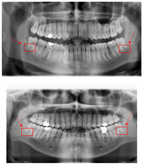 Root Dilaceration Using Deep Learning: A Diagnostic Approach