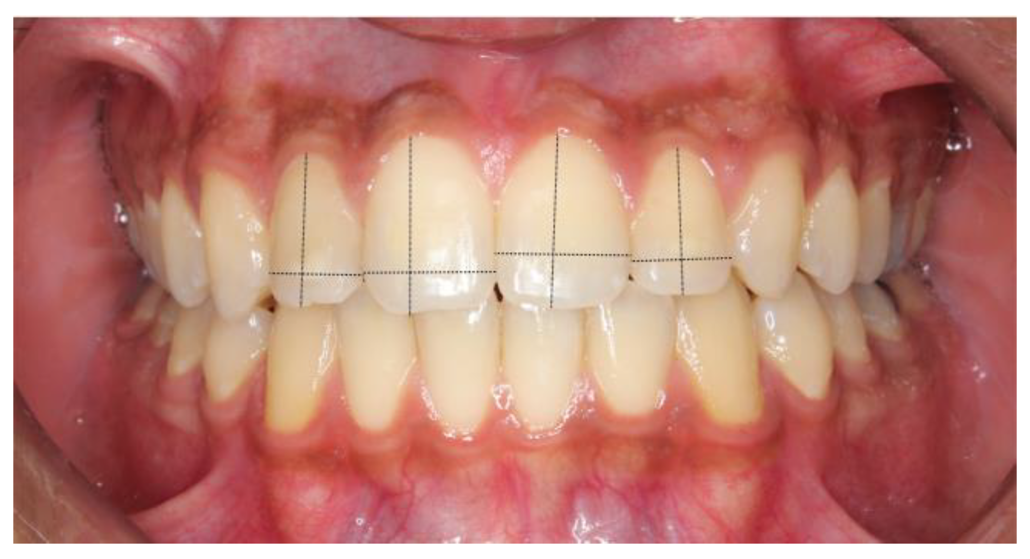 Is Orthodontic Treatment an Etiologic Factor for Altered Passive ...