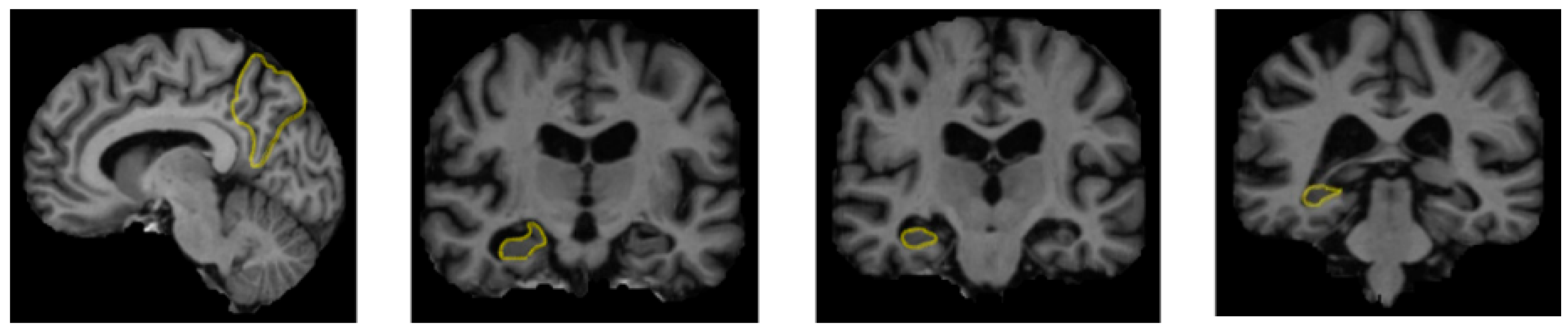Alzheimer’s Disease Diagnosis Using Machine Learning: A Survey