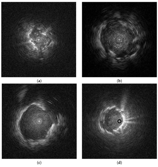 Peripheral Pulmonary Lesions Classification Using Endobronchial ...