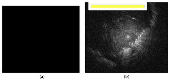 Peripheral Pulmonary Lesions Classification Using Endobronchial ...
