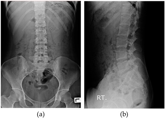 BUU-LSPINE: A Thai Open Lumbar Spine Dataset for Spondylolisthesis ...