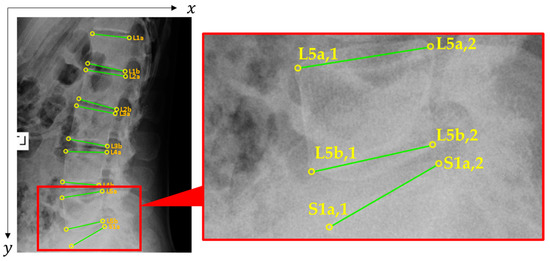 BUU-LSPINE: A Thai Open Lumbar Spine Dataset for Spondylolisthesis ...