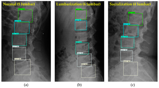 BUU-LSPINE: A Thai Open Lumbar Spine Dataset for Spondylolisthesis Detection