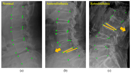 BUU-LSPINE: A Thai Open Lumbar Spine Dataset for Spondylolisthesis ...