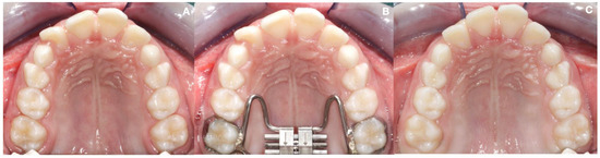 Maxillary Response Induced by Rapid Palatal Expansion vs. Clear ...