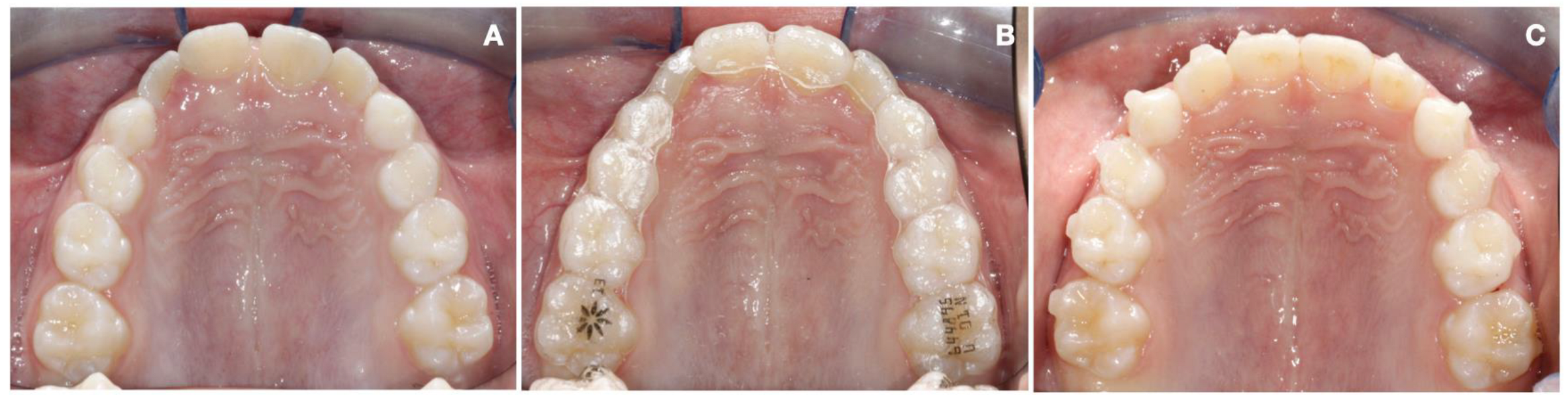 Maxillary Response Induced by Rapid Palatal Expansion vs. Clear ...