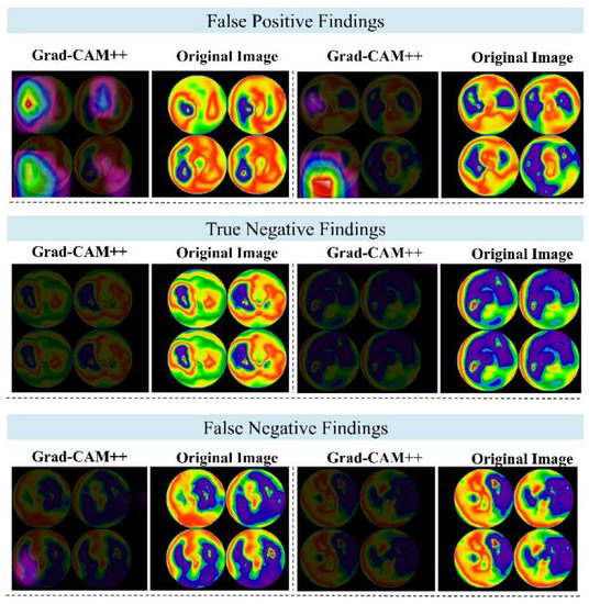 Innovative Attention-Based Explainable Feature-Fusion VGG19 Network for ...
