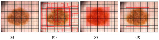 Fuzzy Logic with Deep Learning for Detection of Skin Cancer