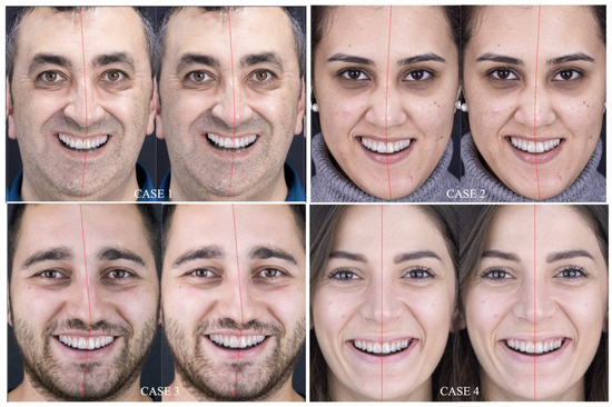 Evaluating the Facial Esthetic Outcomes of Digital Smile Designs ...