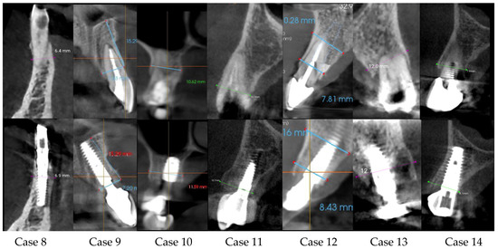Modified Periosteal Inhibition (MPI) Technique for Immediate Implants ...
