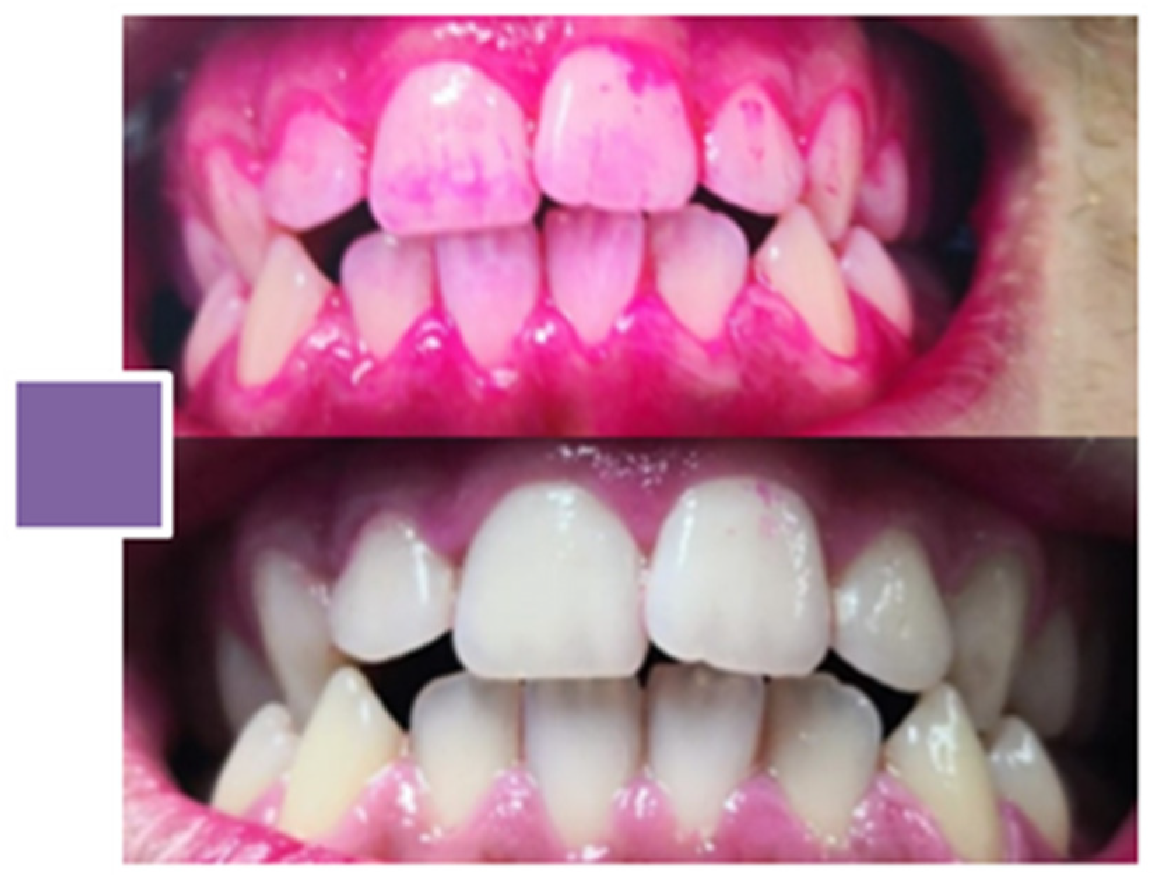 Bacterial Plaque Things You Should Know About Tartar And Dental Plaque