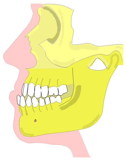 Mandibular Molar Distalization in Class III Malocclusion: A Systematic ...