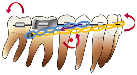 Mandibular Molar Distalization in Class III Malocclusion: A Systematic ...