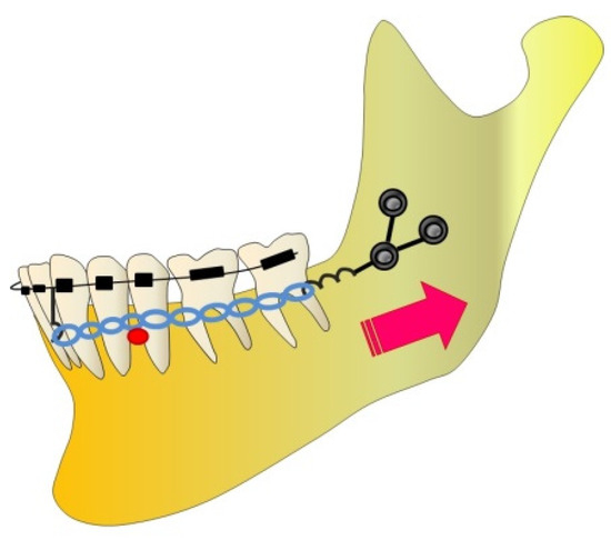 Mandibular Molar Distalization in Class III Malocclusion: A Systematic ...