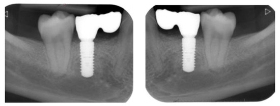 Immediate versus Delayed Implant Placement in Patients with Tooth ...