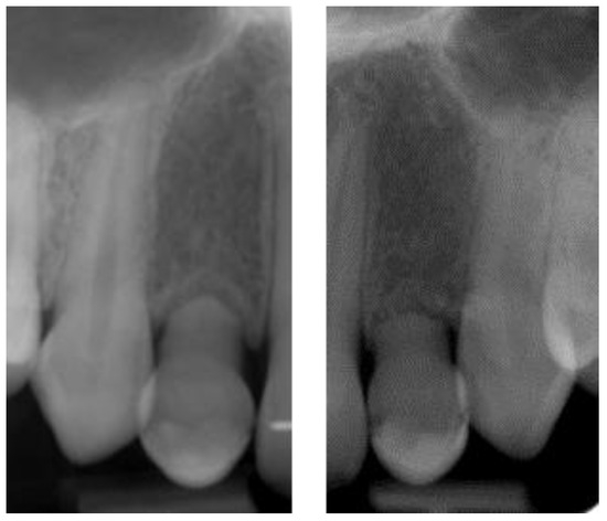 Immediate versus Delayed Implant Placement in Patients with Tooth ...