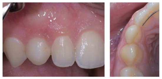 Immediate versus Delayed Implant Placement in Patients with Tooth ...