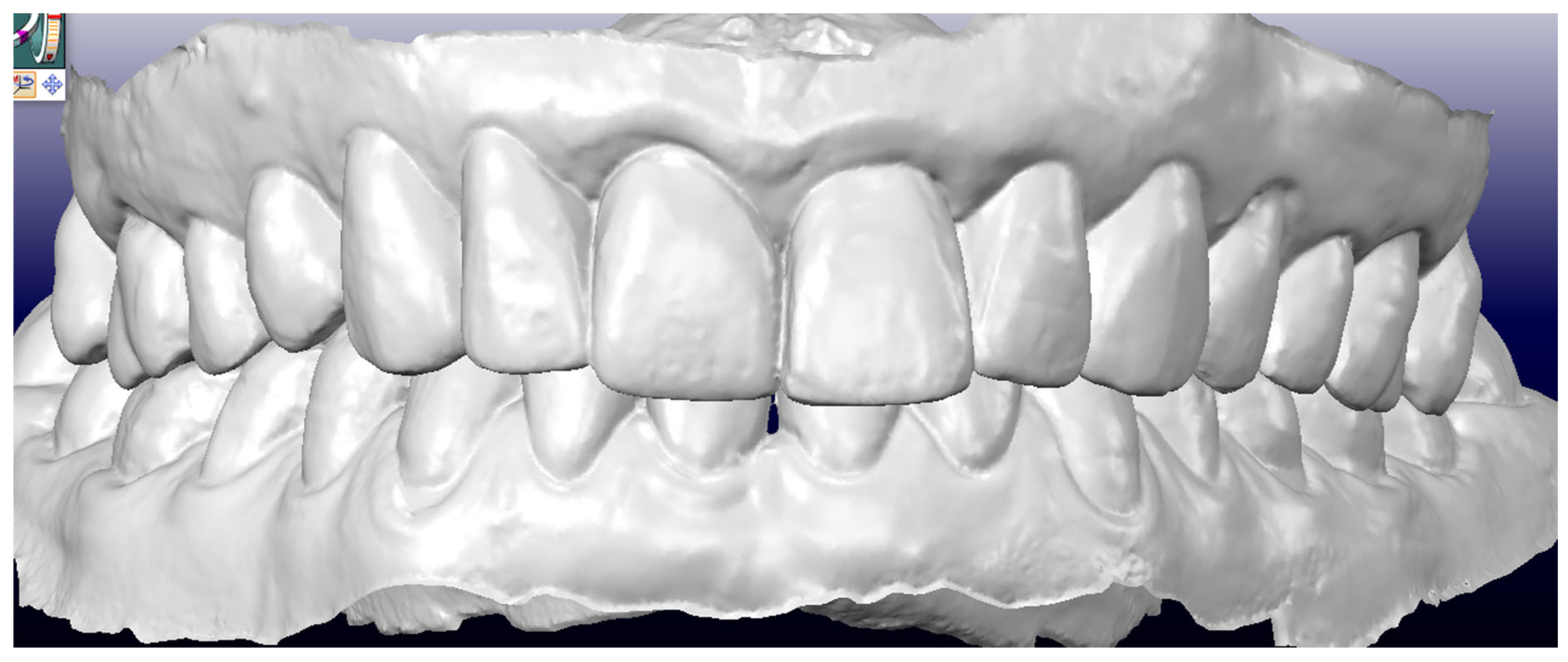 Applied Sciences | Free Full-Text | Clear Aligner Treatment as a Safe ...