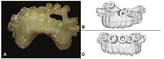 Comparison of the Three-Dimensional Accuracy of Guided Apicoectomy ...
