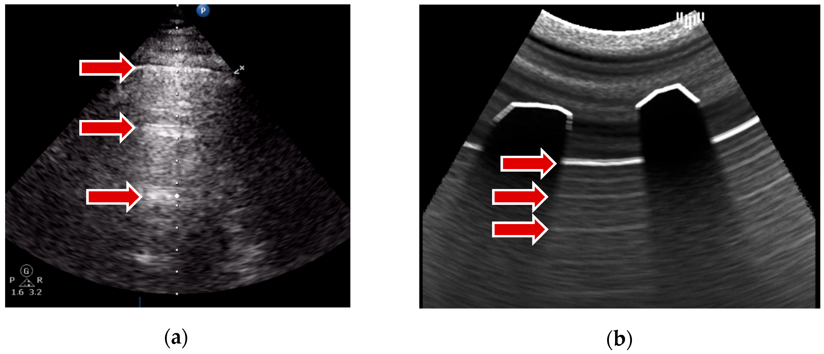 Real-Time Simulation of Wave Phenomena in Lung Ultrasound Imaging