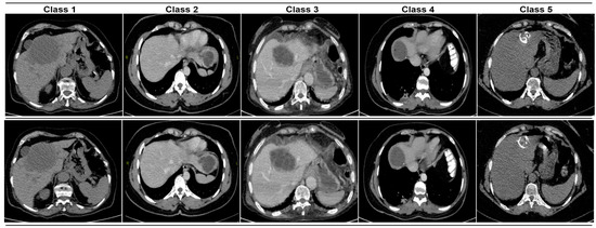 Image Visualization and Classification Using Hydatid Cyst Images with an Explainable Hybrid Model