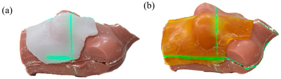 Feasibility of a Patient-Specific Bolus Using the Life-Casting Method ...