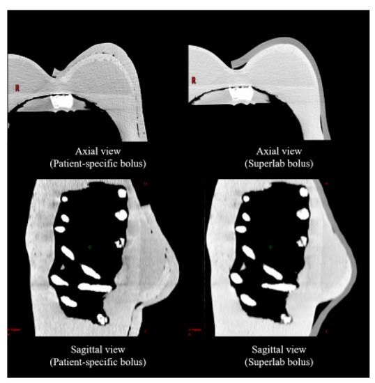Feasibility of a Patient-Specific Bolus Using the Life-Casting Method ...