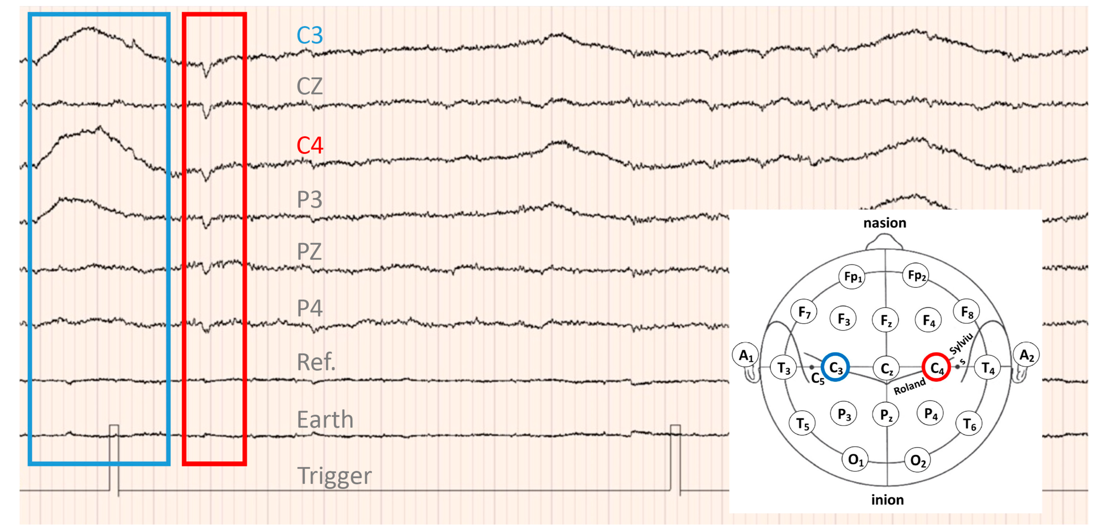Development of an Application That Implements a Brain–Computer Interface to an Upper-Limb Motor ...