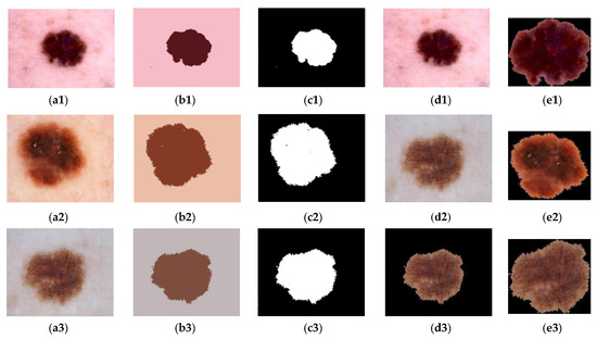 An Identification Method of Feature Interpretation for Melanoma Using ...