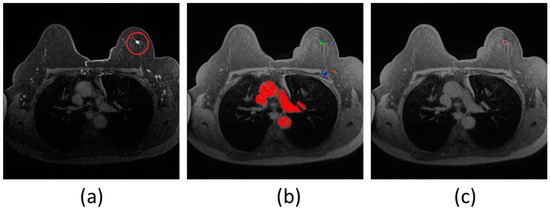 Fully Automatic Thoracic Cavity Segmentation in Dynamic Contrast Enhanced Breast MRI Using Deep ...