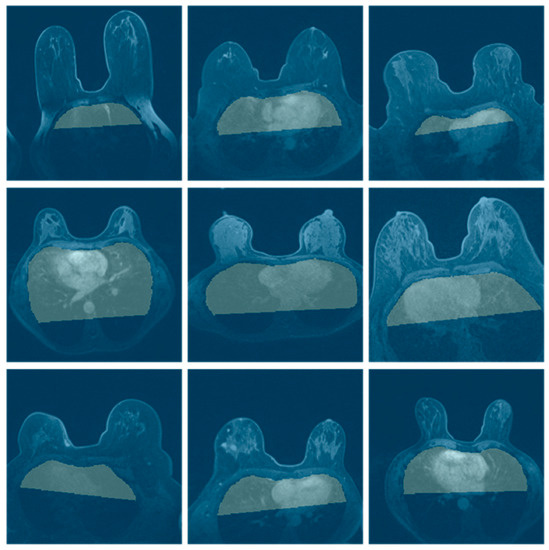 Fully Automatic Thoracic Cavity Segmentation in Dynamic Contrast Enhanced Breast MRI Using Deep ...
