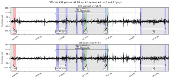 Applied Sciences | Free Full-Text | Distributional Representation of Cyclic Alternating Patterns ...