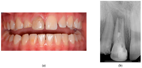 Application of Hyperpure Chlorine Dioxide for Regenerative Endodontic ...