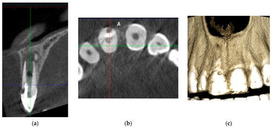 Application of Hyperpure Chlorine Dioxide for Regenerative Endodontic ...