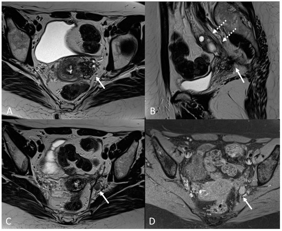 Magnetic Resonance Roadmap in Detecting and Staging Endometriosis ...