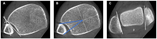 Ins and Outs of the Ankle Syndesmosis from a 2D to 3D CT Perspective
