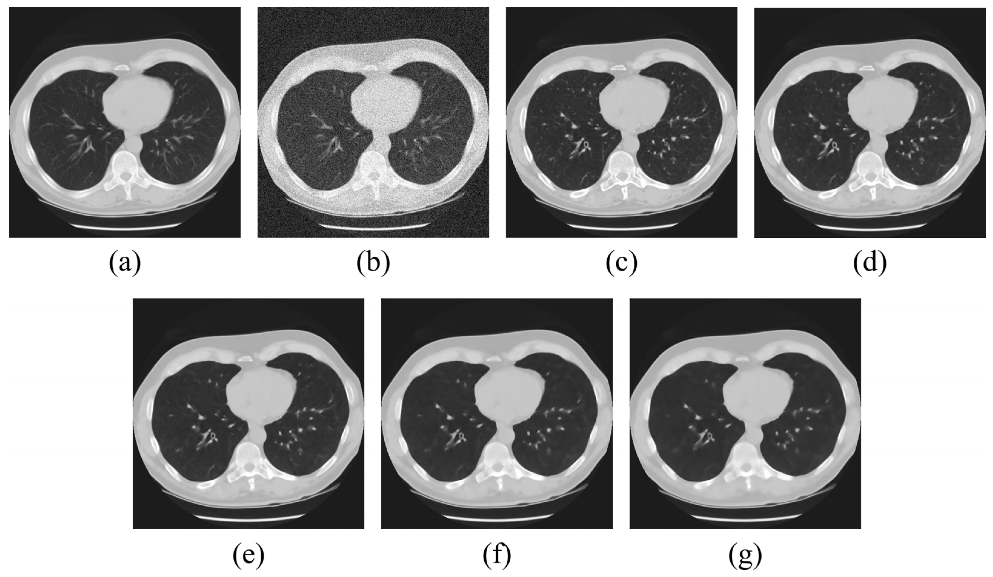 Optimization of Median Modified Wiener Filter for Improving Lung Segmentation Performance in Low ...