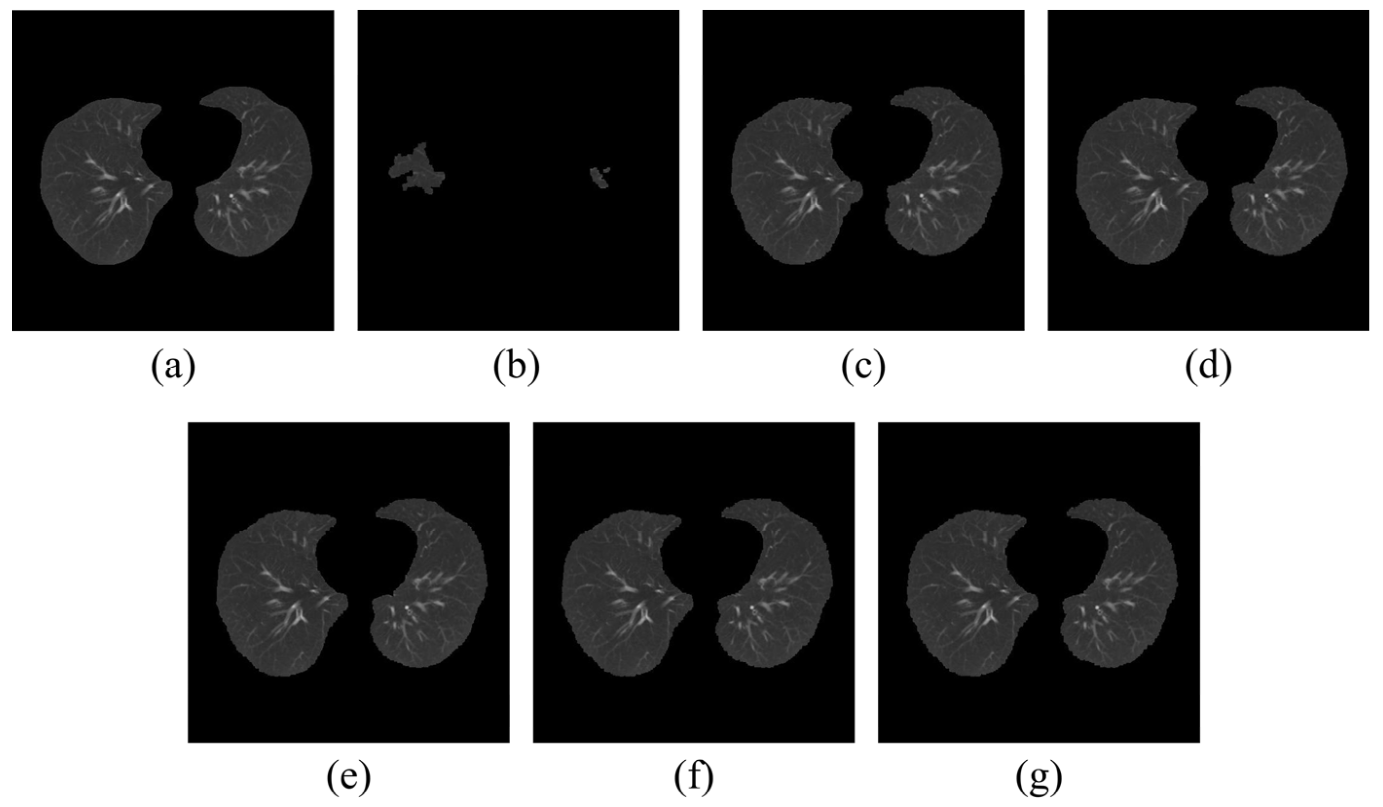 Optimization of Median Modified Wiener Filter for Improving Lung Segmentation Performance in Low ...