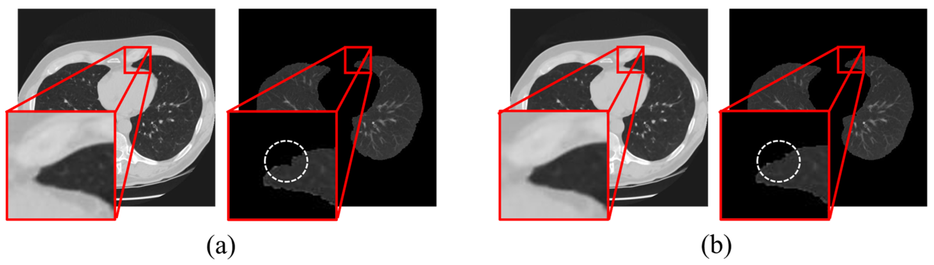 Optimization of Median Modified Wiener Filter for Improving Lung Segmentation Performance in Low ...